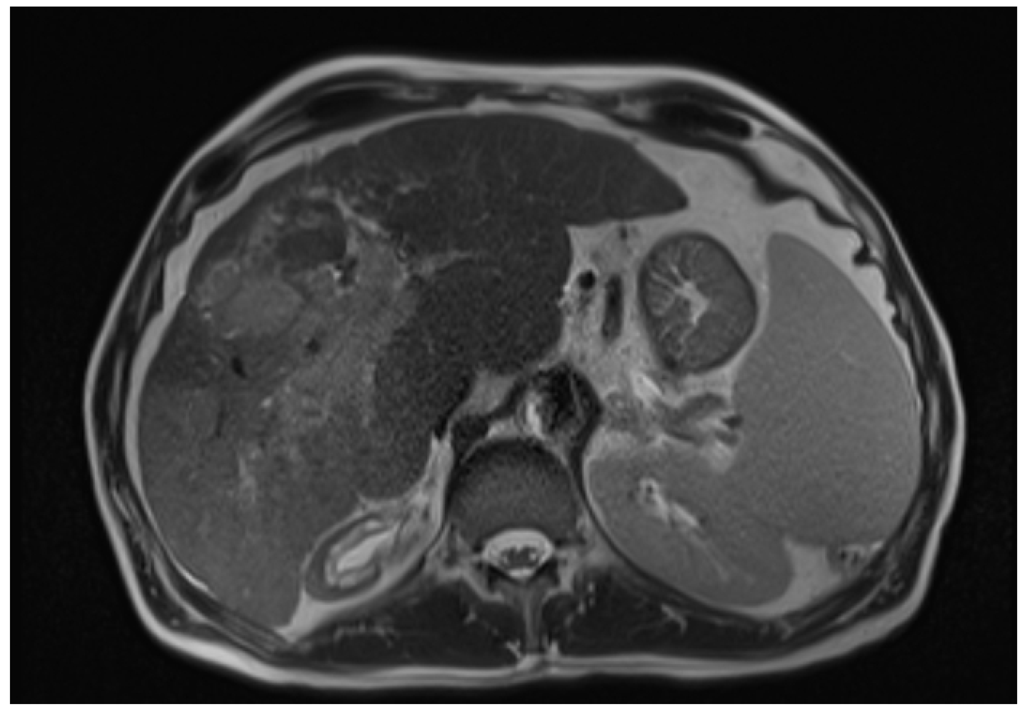Cancers | Free Full-Text | Recent Advances in Locoregional Therapy of ...