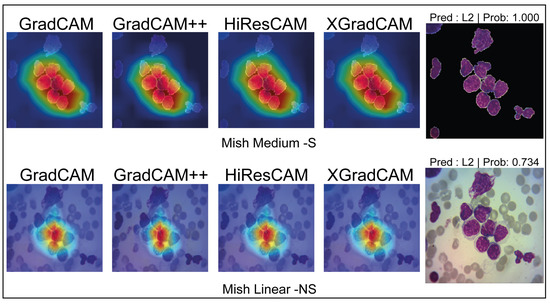 Explainable CAD System for Classification of Acute Lymphoblastic ...