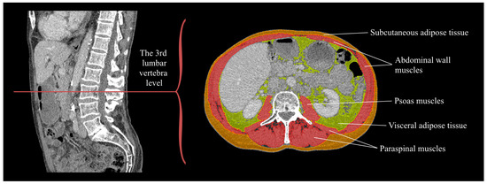 Cancers | Free Full-Text | Association between Computed Tomography ...