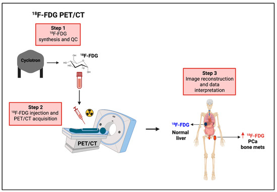 Lactate as Key Metabolite in Prostate Cancer Progression: What Are the ...