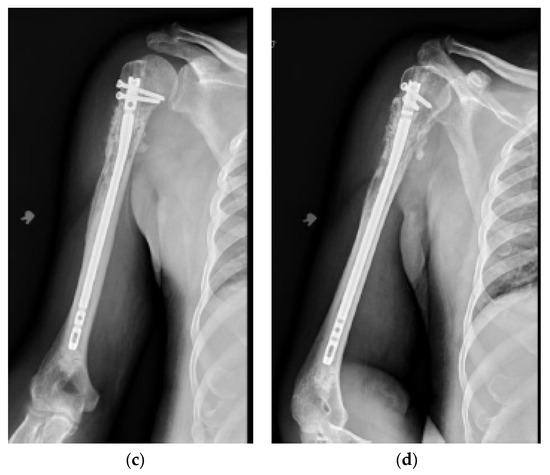 Intramedullary Nailing with and without the Use of Bone Cement for Impending and Pathologic ...