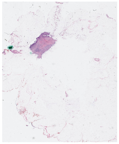 Automated Detection and Scoring of Tumor-Infiltrating Lymphocytes in ...
