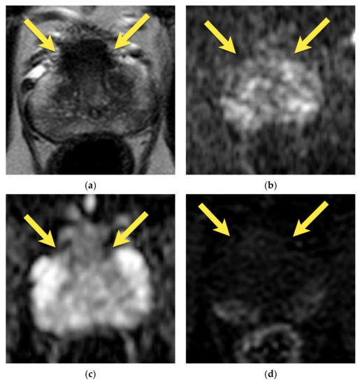 Prostate Cancer and Its Mimics—A Pictorial Review