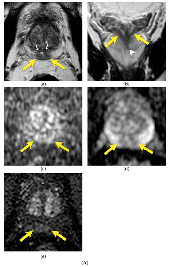 Prostate Cancer and Its Mimics—A Pictorial Review