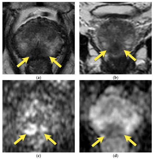 Prostate Cancer and Its Mimics—A Pictorial Review