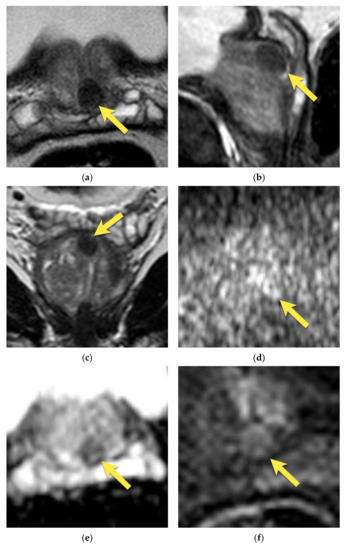 Prostate Cancer and Its Mimics—A Pictorial Review