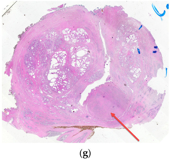Prostate Cancer and Its Mimics—A Pictorial Review