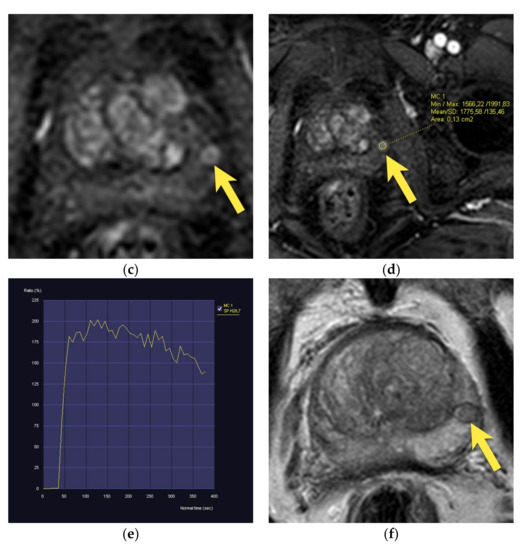 Prostate Cancer and Its Mimics—A Pictorial Review