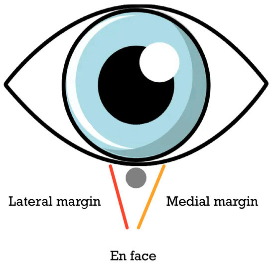 Recurrence of Basal Cell Carcinoma Treated with Surgical Excision and ...