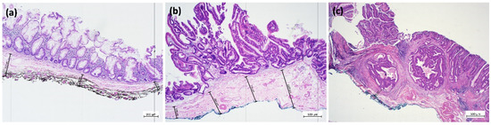 Endoscopic Treatment of T1 Colorectal Cancer