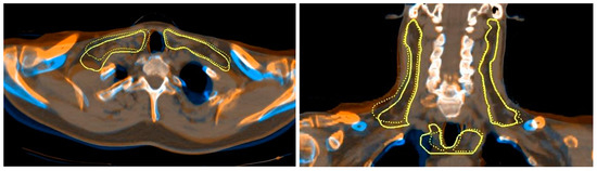 CBCT-Based Dose Monitoring and Adaptive Planning Triggers in Head and ...