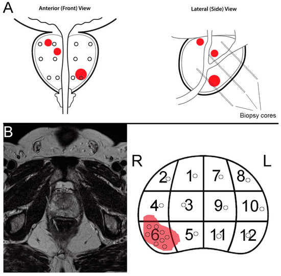 MRI-Guided Targeted and Systematic Prostate Biopsies as Prognostic Indicators for Prostate ...