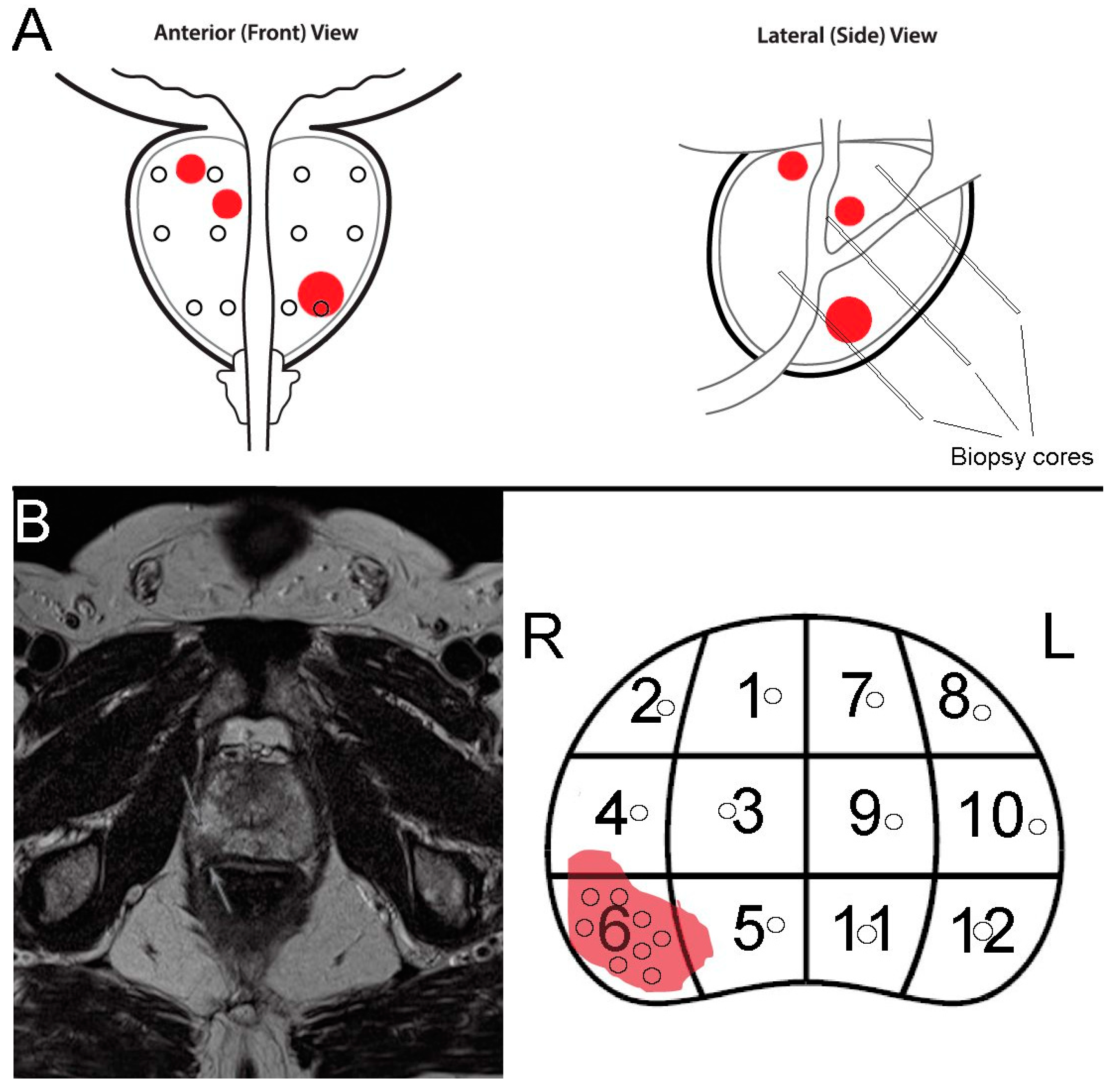 Cancers Free Full Text Mri Guided Targeted And Systematic Prostate