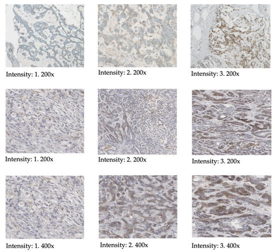 Novel Discovery of the Somatostatin Receptor (SSTR2) in Pleomorphic ...