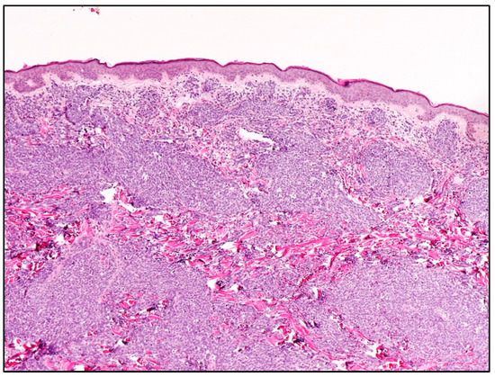 Skin Involvement by Hematological Neoplasms with Blastic Morphology ...