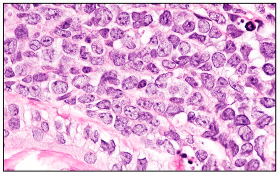 Skin Involvement by Hematological Neoplasms with Blastic Morphology ...