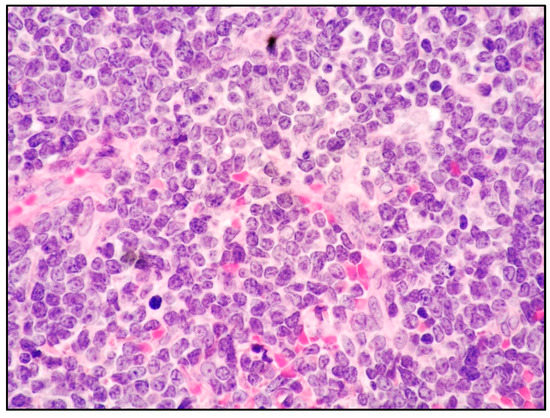 Skin Involvement by Hematological Neoplasms with Blastic Morphology ...