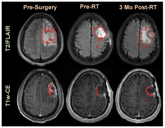 A Fully Automated Post-Surgical Brain Tumor Segmentation Model for ...