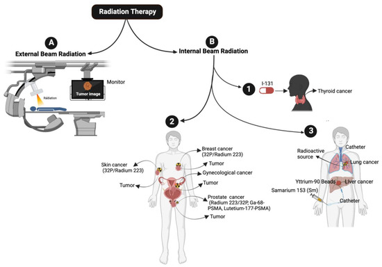 Radiation Therapy Diagram