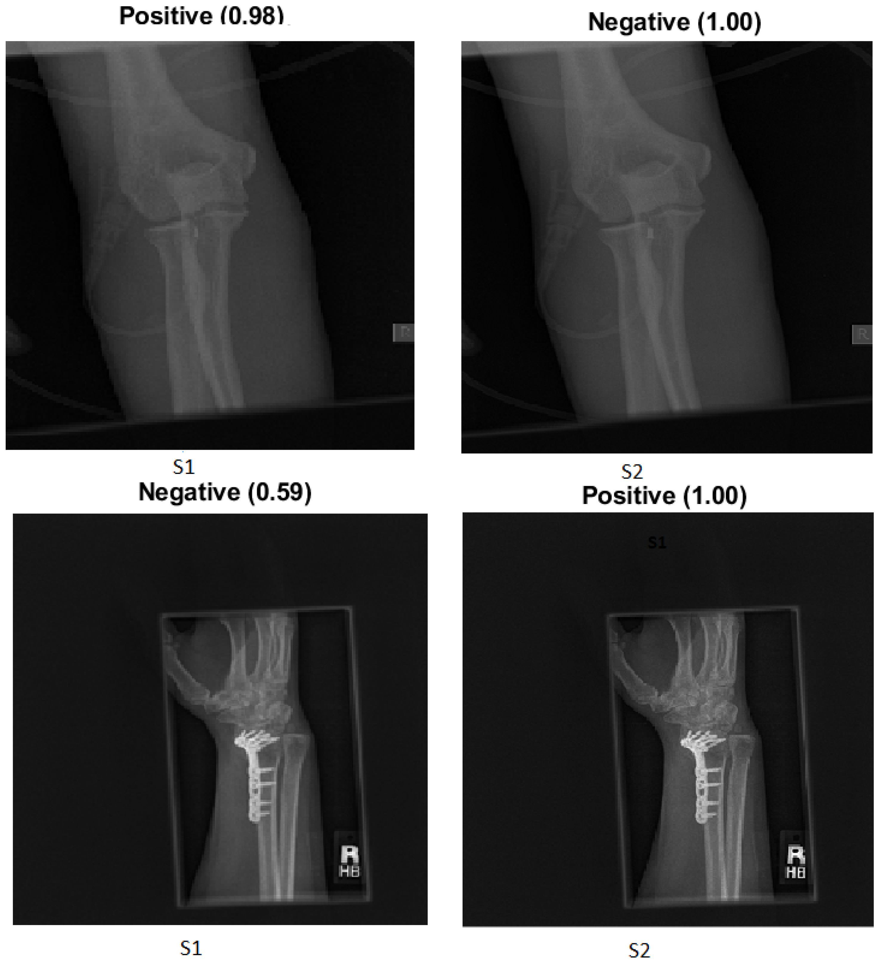 Deep Transfer Learning with Enhanced Feature Fusion for Detection of ...