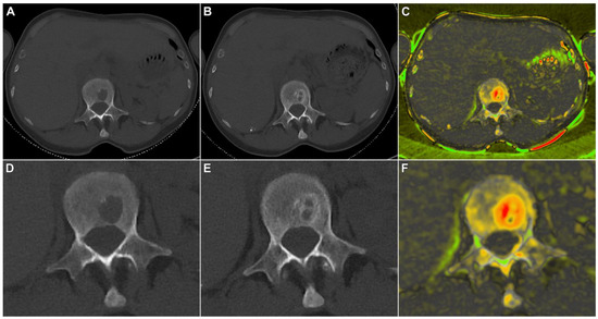 Assessing Osteolytic Lesion Size on Sequential CT Scans Is a Reliable ...
