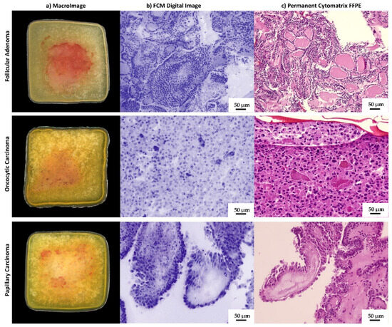 Real-Time Evaluation of Thyroid Cytology Using New Digital Microscopy ...