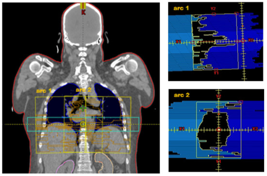 Optimized Conformal Total Body Irradiation with VMAT Using a Linear ...
