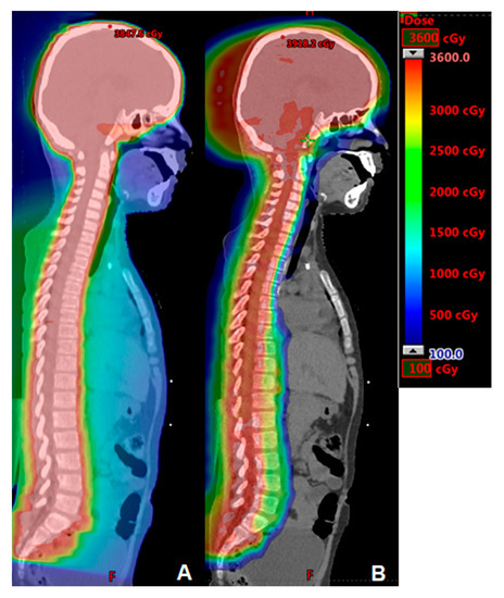 Cancers | Free Full-Text | Proton Therapy in the Adolescent and Young ...