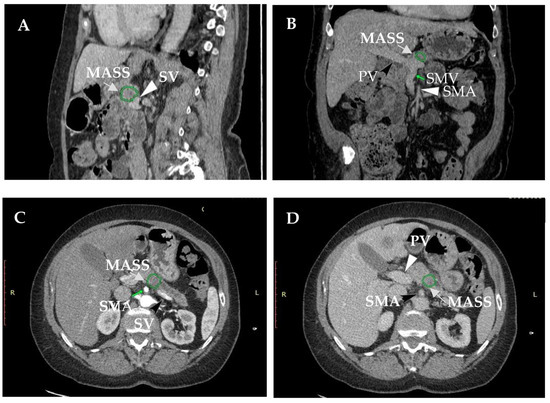 How A Patient with Resectable or Borderline Resectable Pancreatic ...