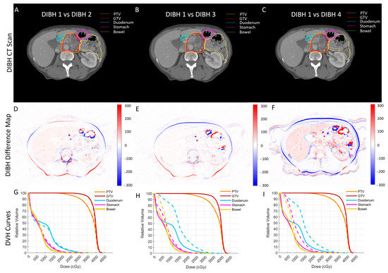 Cancers | Free Full-Text | Inter-Breath-Hold Geometric and Dosimetric ...