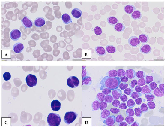 Atypical Chronic Lymphocytic Leukemia—The Current Status