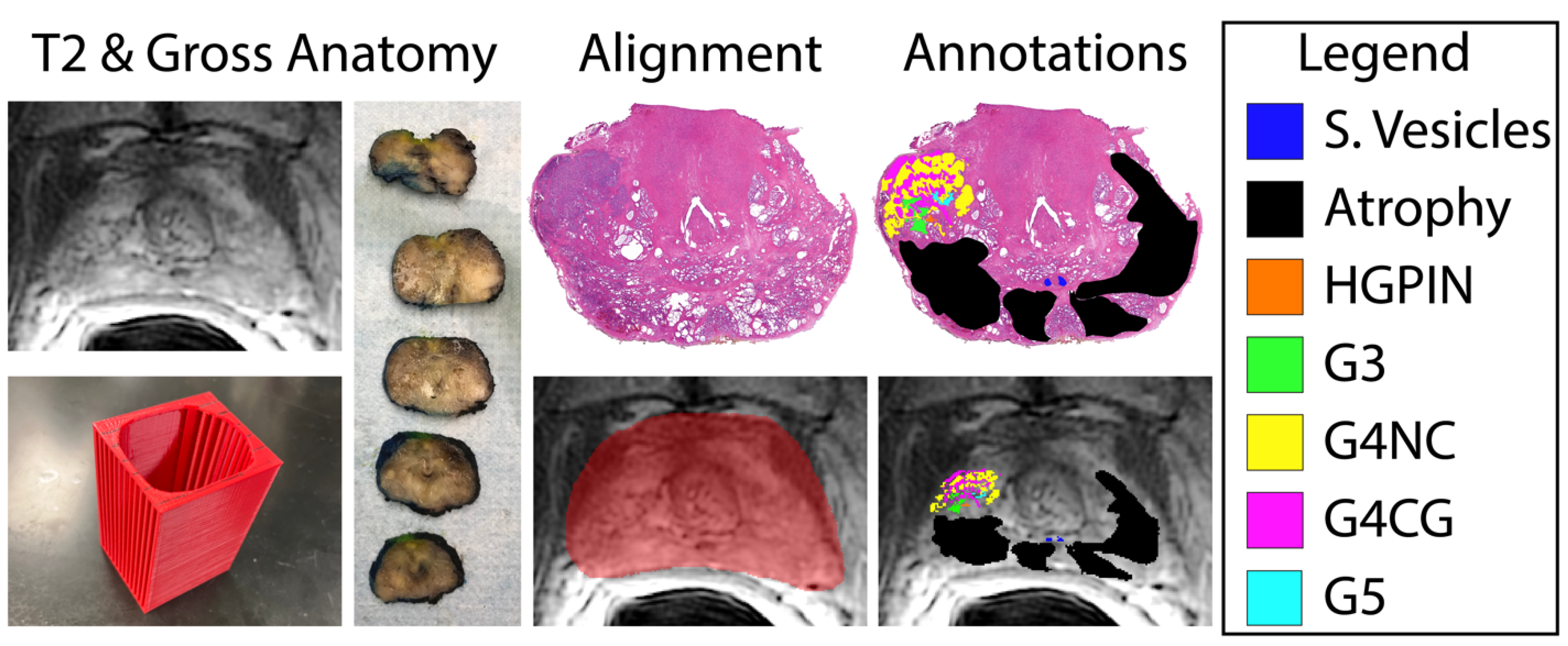 Cancers Free Full Text T2 Weighted Mri Radiomic Features Predict