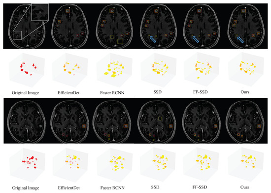 Cancers | Free Full-Text | Automatic Detection of Brain Metastases in T1-Weighted Construct ...