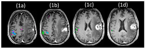 Detection and Mitigation of Neurovascular Uncoupling in Brain Gliomas