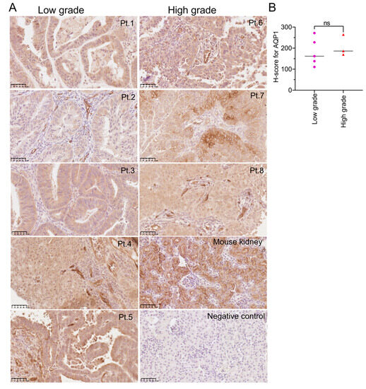 Reducing the Invasiveness of Low- and High-Grade Endometrial Reducing the Invasiveness of Low- and High-Grade Endometrial