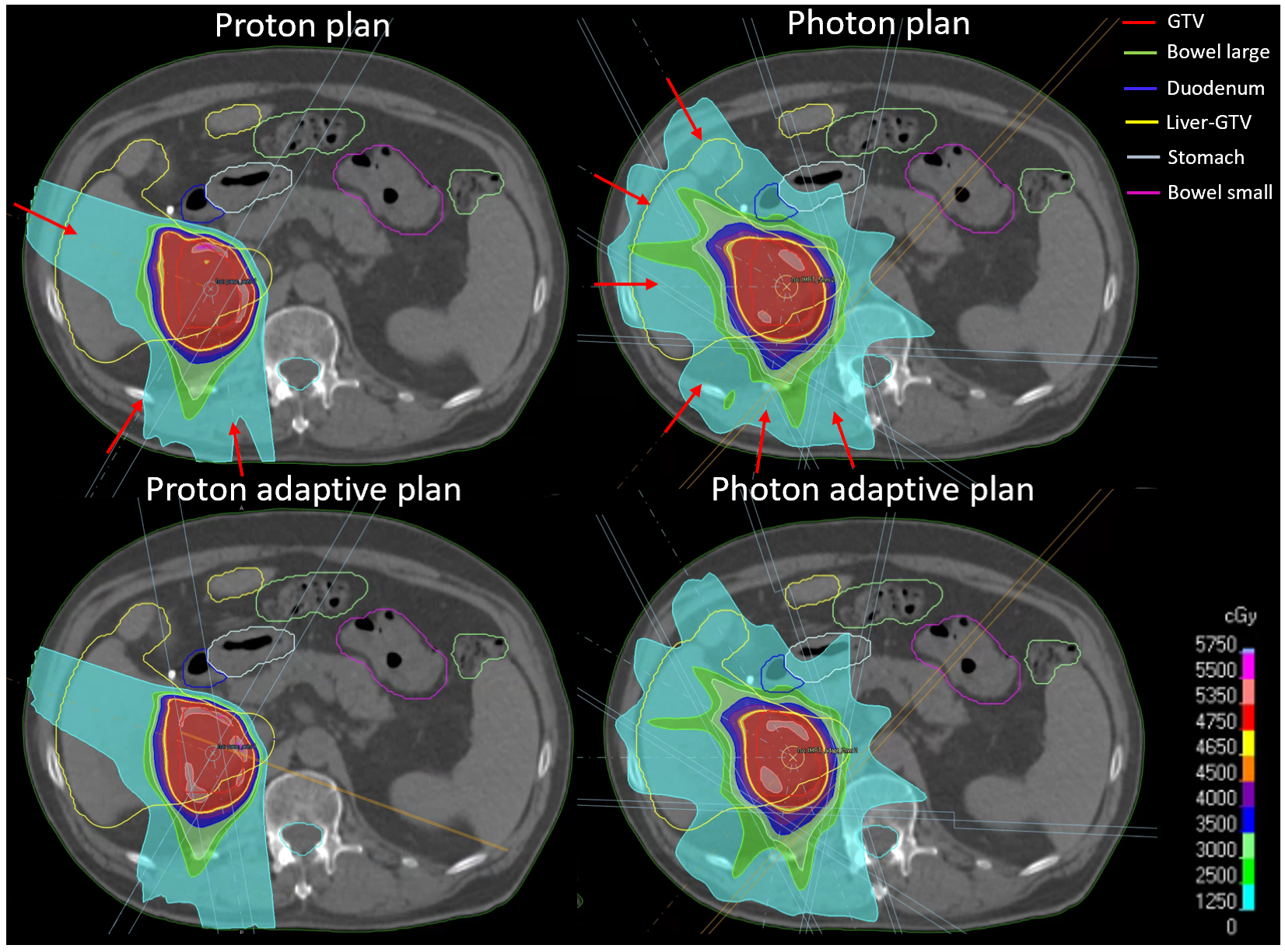 Comparing Predicted Toxicities between Hypofractionated Proton and ...
