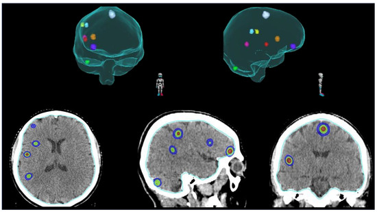 Cancers | Free Full-Text | Modern Stereotactic Radiotherapy for Brain Metastases from Lung ...