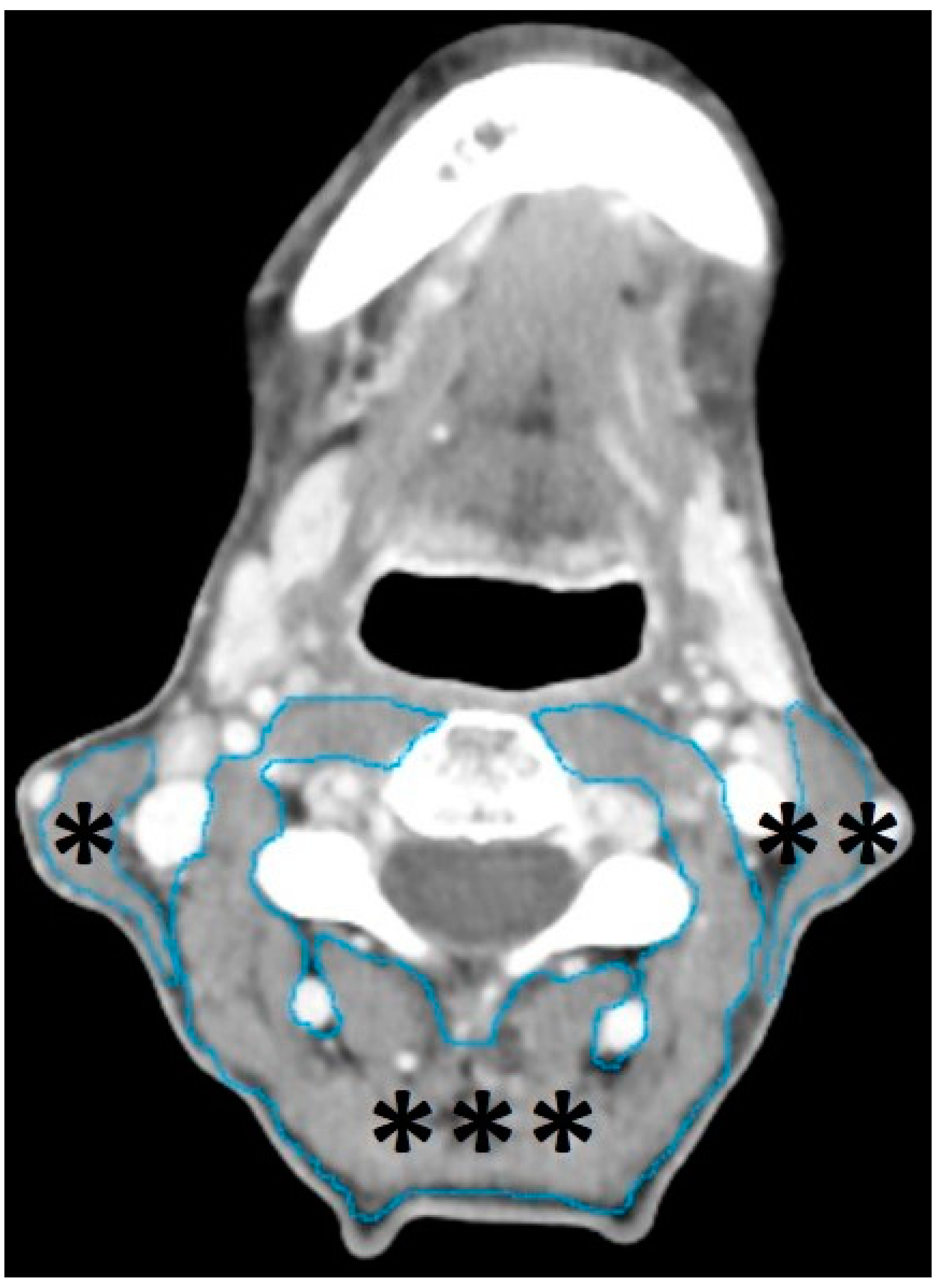 Radiomic Assessment of Radiation-Induced Alterations of Skeletal Muscle ...