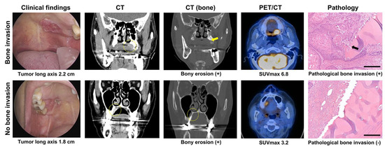 Prediction of Maxillary Bone Invasion in Hard Palate/Upper Alveolus ...