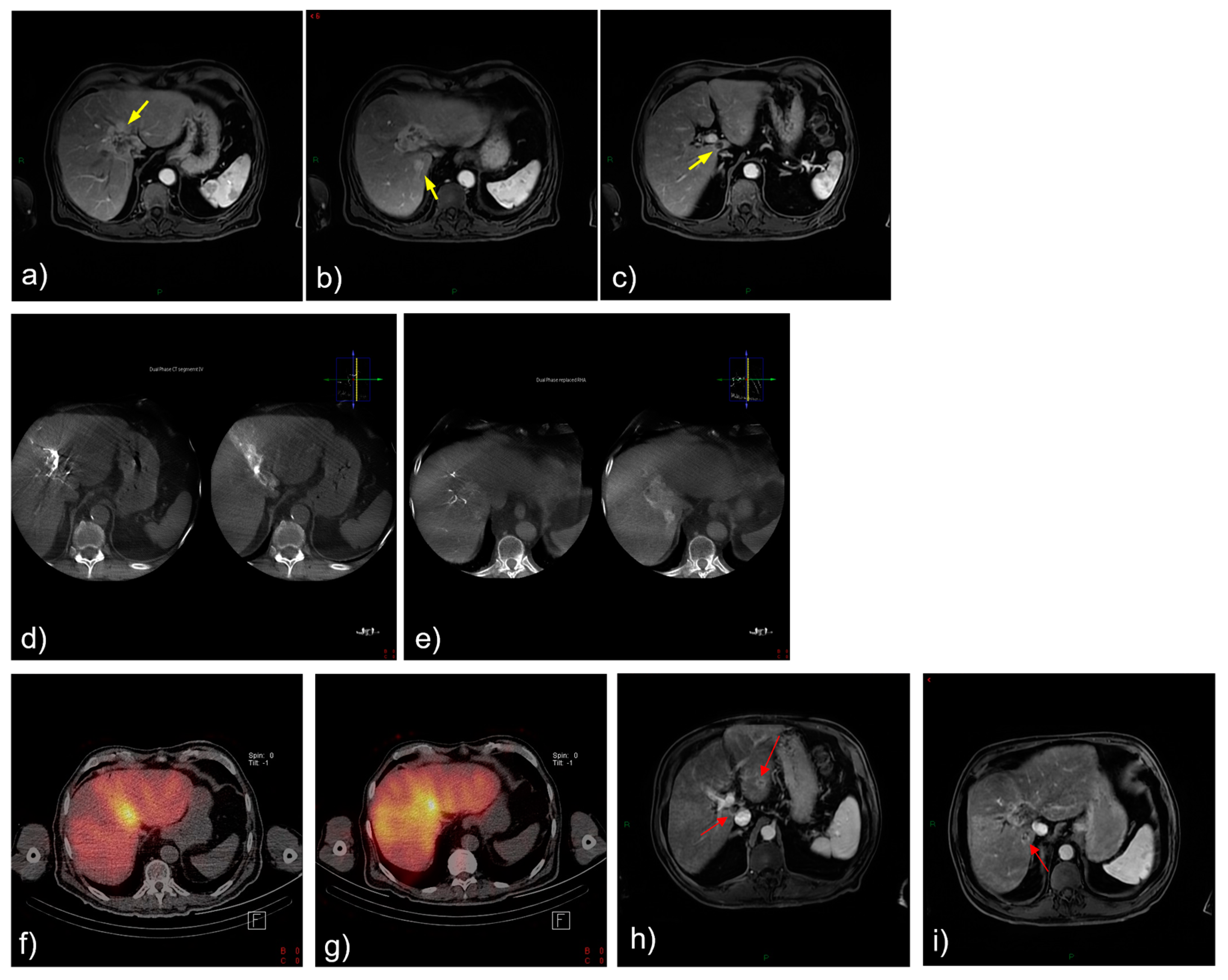 Cancers | Free Full-Text | Holmium-166 Transarterial Radioembolization for the Treatment of ...