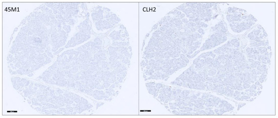 Differential Expression and Diagnostic Value of MUC5AC Glycoforms in ...