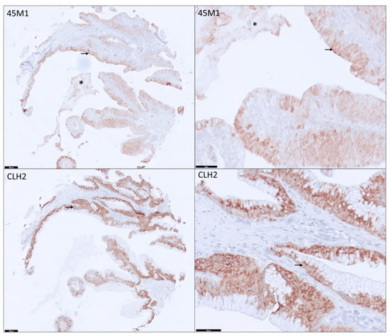 Differential Expression and Diagnostic Value of MUC5AC Glycoforms in ...