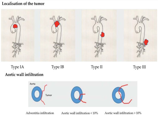 T4 Lung Carcinoma with Infiltration of the Thoracic Aorta: Indication ...