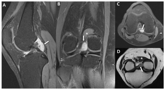 Synovial Sarcoma in the Extremity: Diversity of Imaging Features for ...