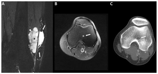 Synovial Sarcoma in the Extremity: Diversity of Imaging Features for ...