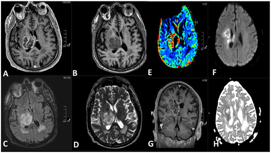 Decoding Diffuse Midline Gliomas: A Comprehensive Review of ...