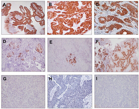 Cancers | Free Full-Text | Stress Keratin 17 Is a Predictive Biomarker ...