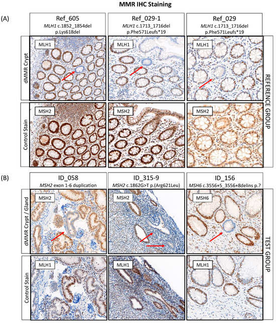 DNA Mismatch Repair Gene Variant Classification: Evaluating the Utility of Somatic Mutations and ...