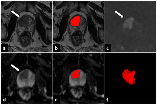 Cancers | Free Full-Text | Towards the Definition of Radiomic Features ...
