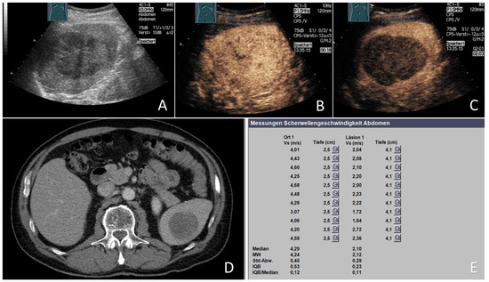 Acoustic Radiation Force Impulse (ARFI) Elastography of Focal Splenic ...